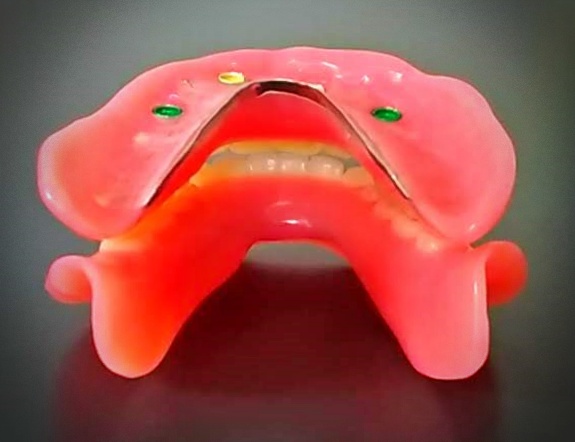 Locator Implant Supported Dentures - ProCare Denture Clinic & Implant ...